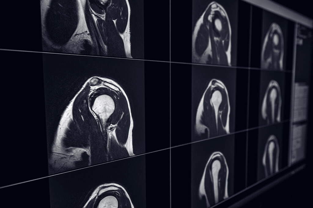 What should I expect during a shoulder MRI? • Gateway Diagnostic Imaging
