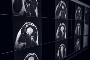 What should I expect during a shoulder MRI? • Gateway Diagnostic Imaging