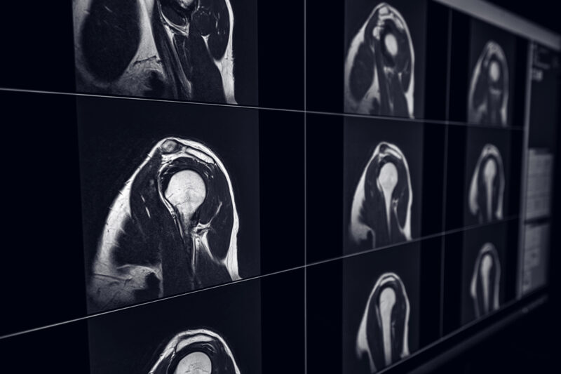 What should I expect during a shoulder MRI? • Gateway Diagnostic Imaging