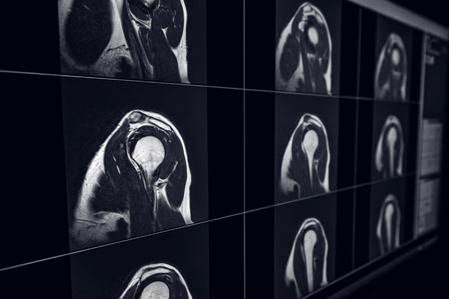 What should I expect during a shoulder MRI? • Gateway Diagnostic Imaging